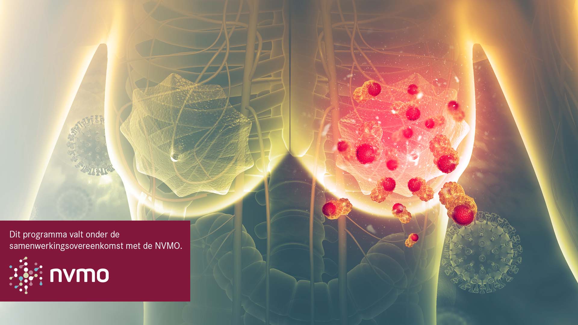 HER2-positief mammacarcinoom - NVMO